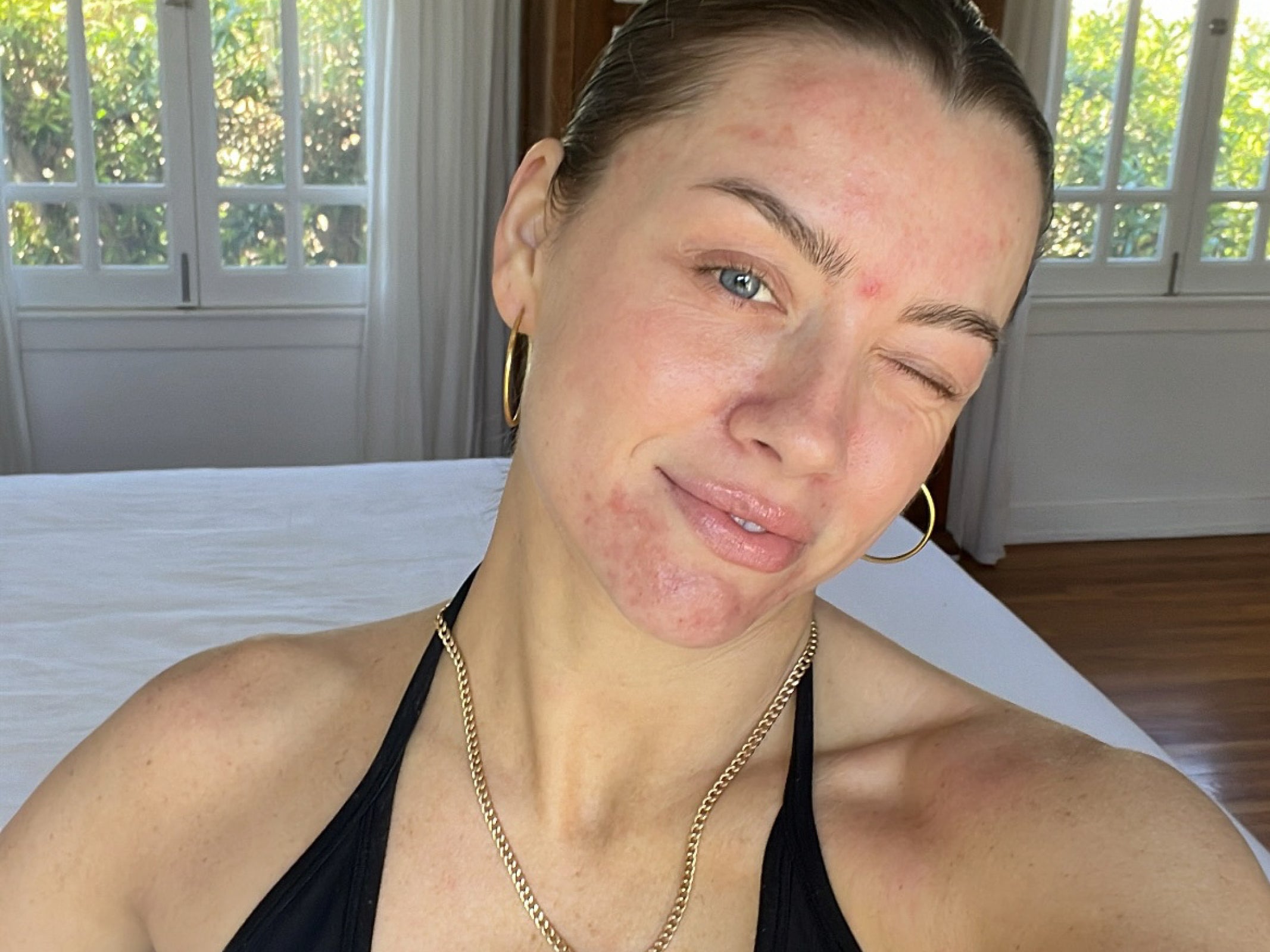 Got Adult Acne You re Not The Only One