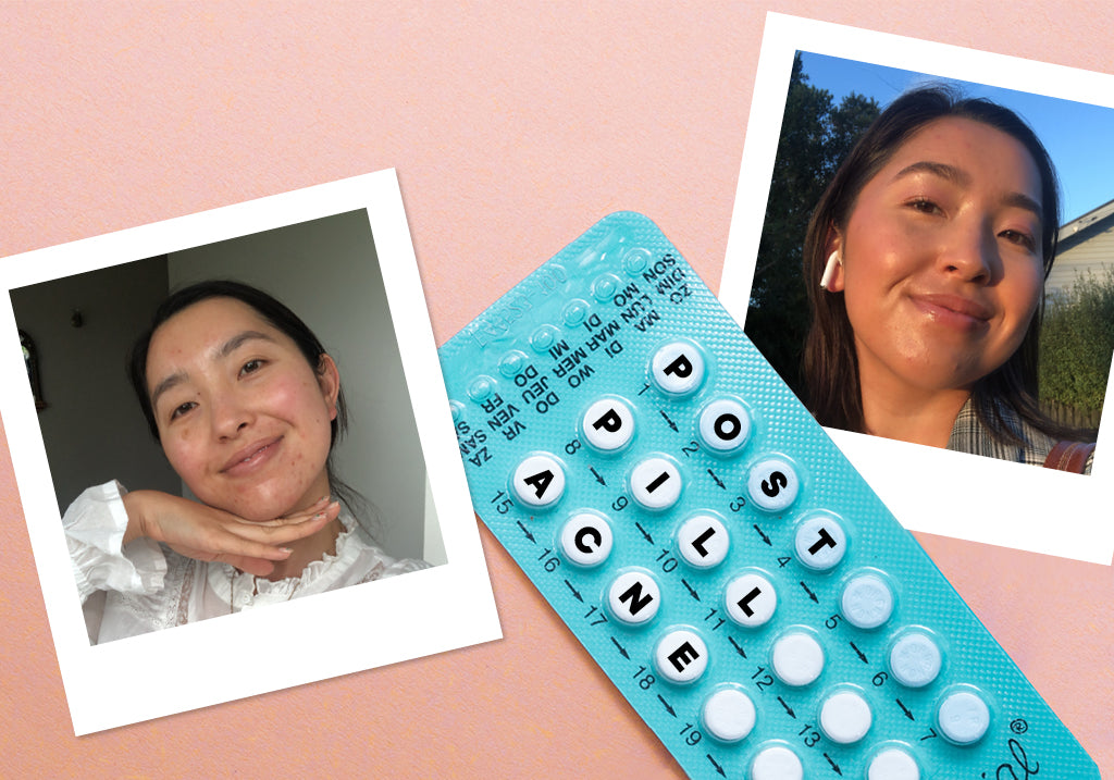 Post Pill Acne Skincare | Go-To Guide | Go-To Skin Care